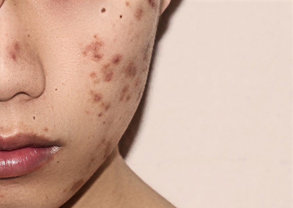 Models With Acne UK Models